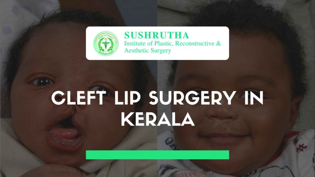 Cleft Lip surgery in kerala - Kerala’s Leading Centre for Cosmetic ...